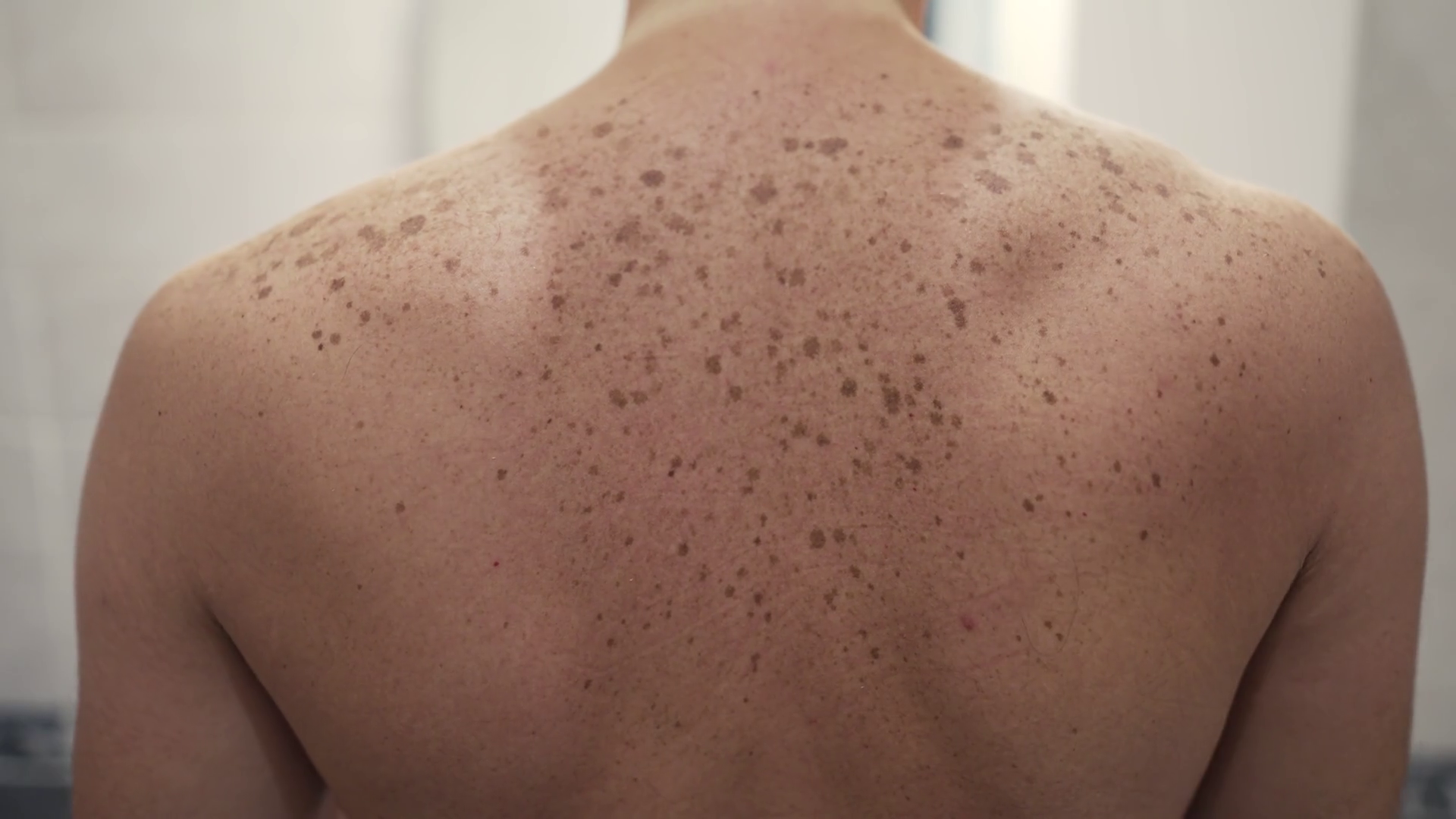 Pigmented Skin On Man's Back Stock Footage SBV-348654360 - Storyblocks