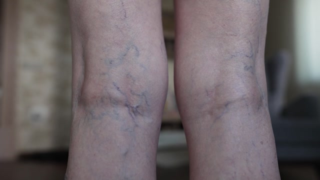 Swollen Legs Stock Footage: Royalty-Free Video Clips - Storyblocks