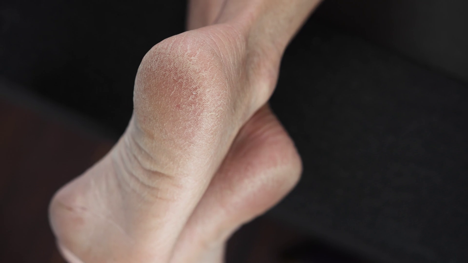 Rough Female Heels Problematic Dehydrated Stock Footage SBV-348816576 ...