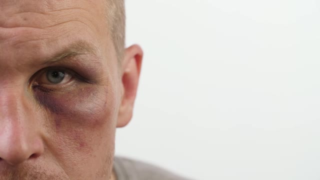 Black Eye Stock Footage: Royalty-Free Video Clips - Storyblocks