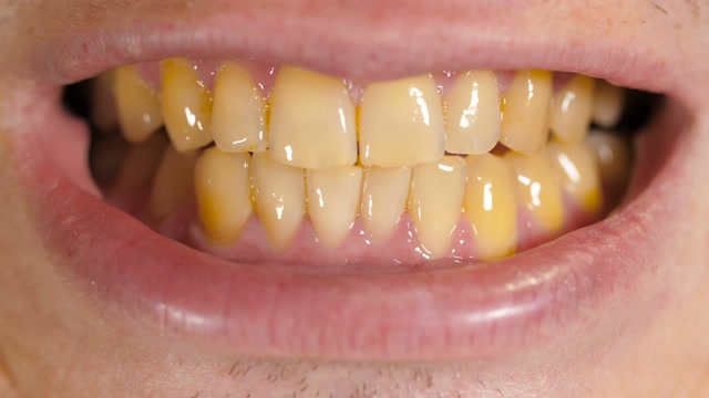 Yellow Teeth Stock Footage: Royalty-Free Video Clips - Storyblocks
