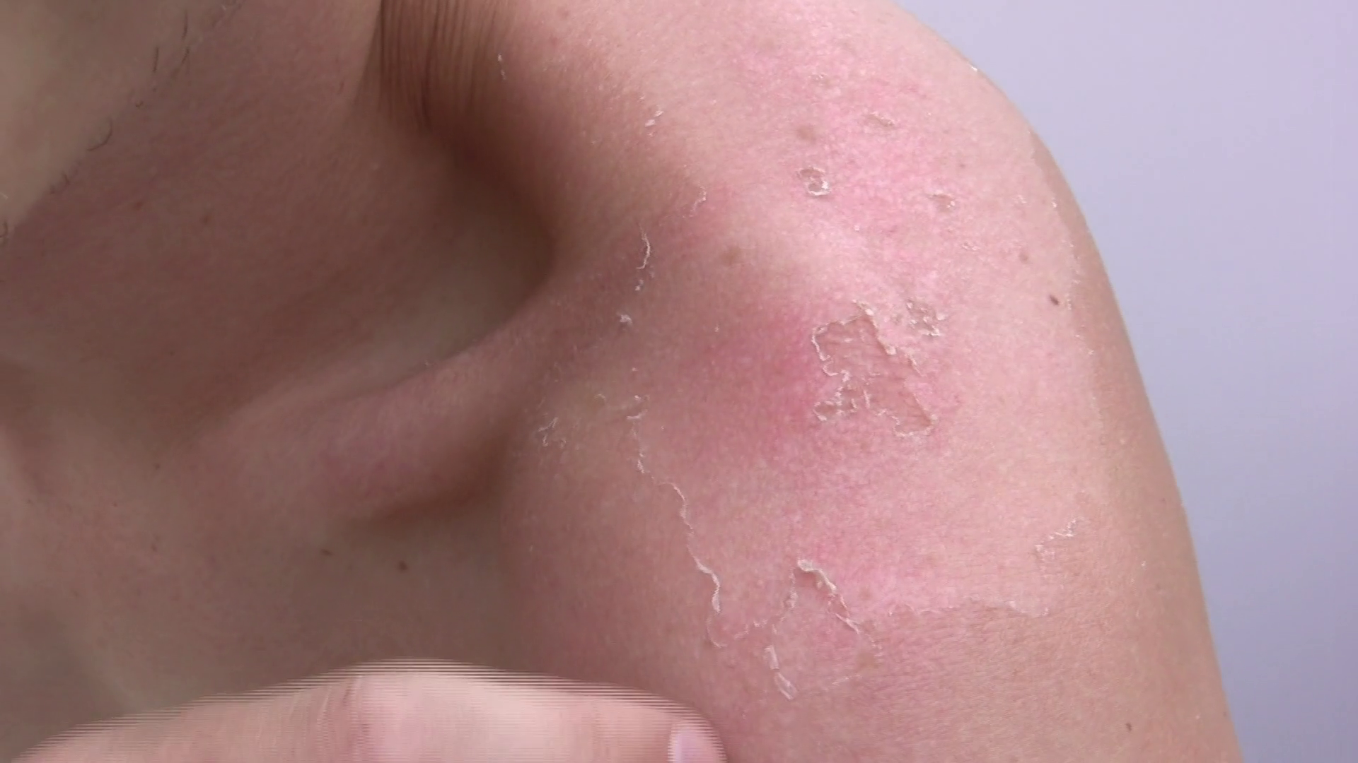 Man Peeling Skin From Shoulder Stock Footage SBV-300817459 - Storyblocks