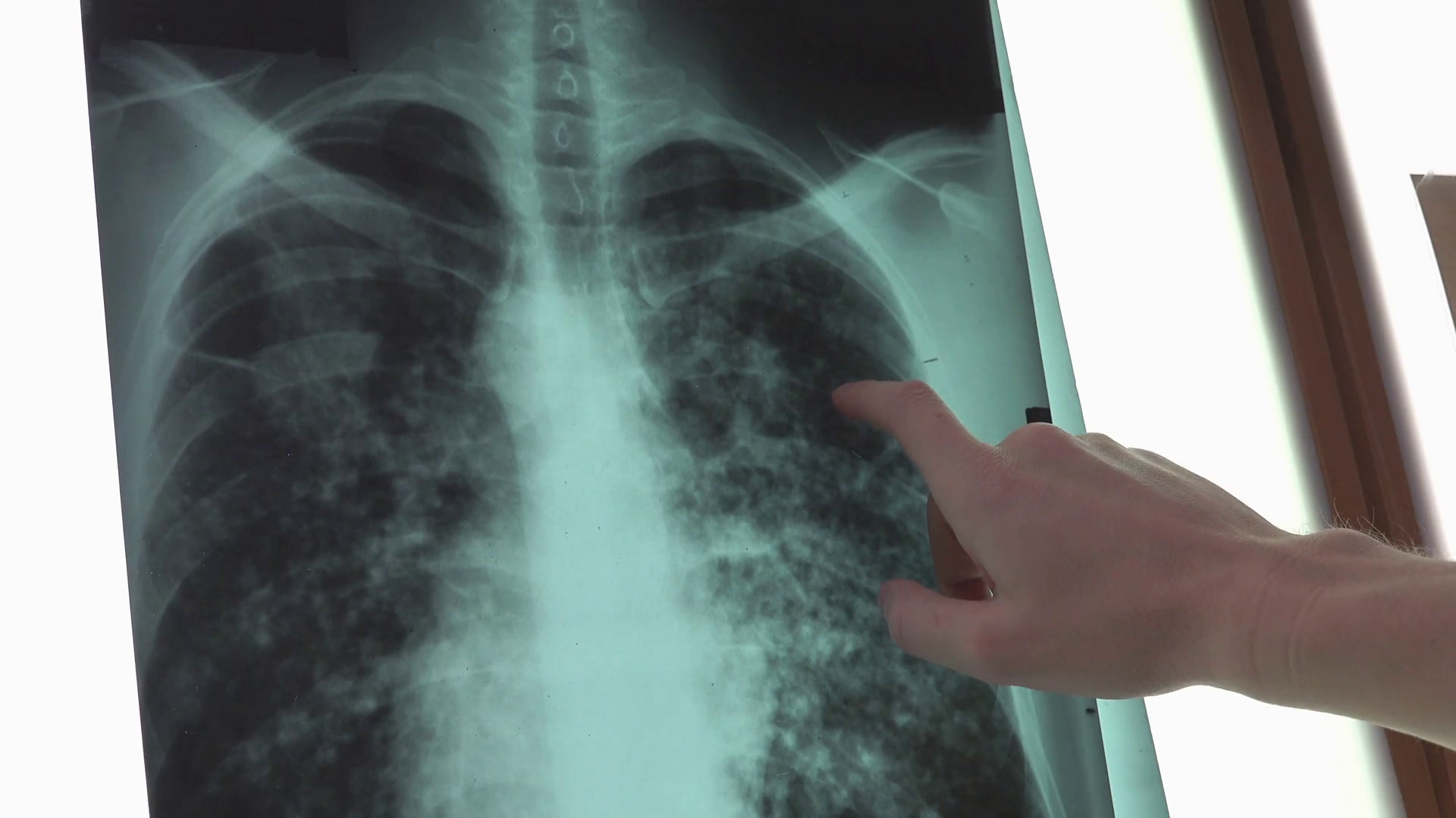 Rib Cage X-ray With Doctor Pointing Out Stock Footage SBV-302484343 ...