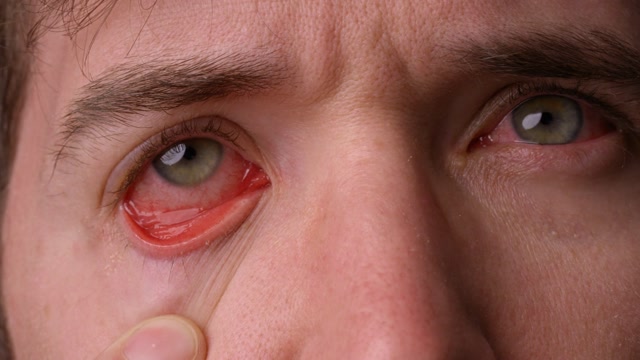 Eye Infection Stock Footage: Royalty-Free Video Clips - Storyblocks
