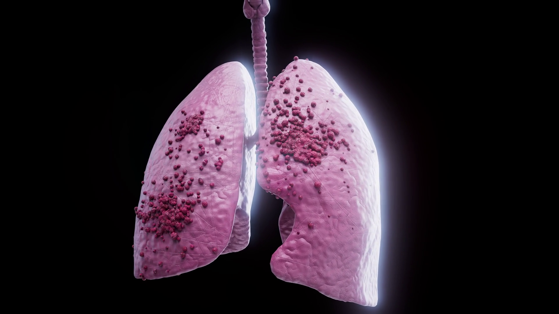 Conceptual Animation Of Lung Cancer Stock Motion Graphics SBV-351737115 - Storyblocks