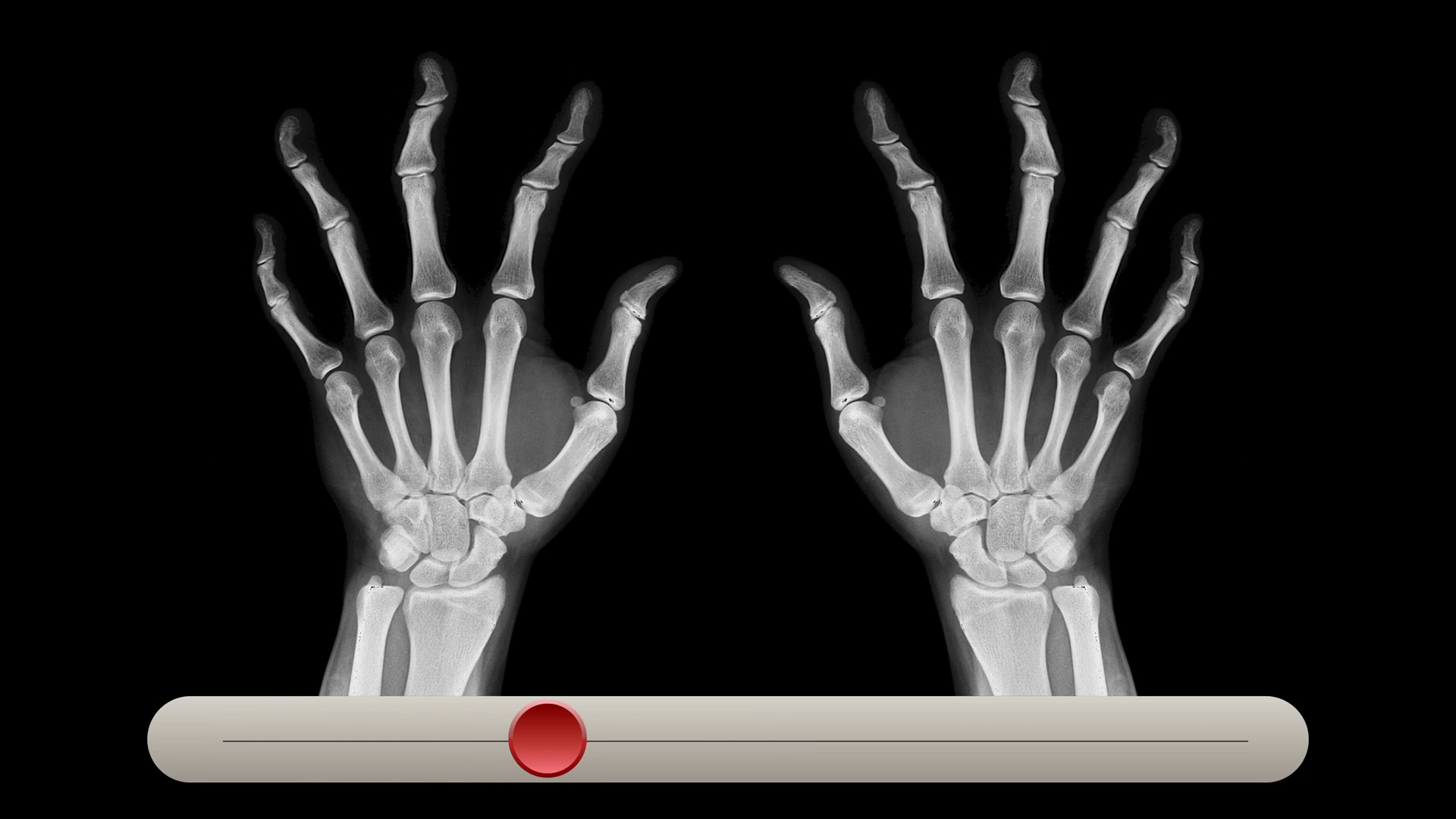 11297 A rheumatoid arthritis simulation screen. Stock Video Footage ...