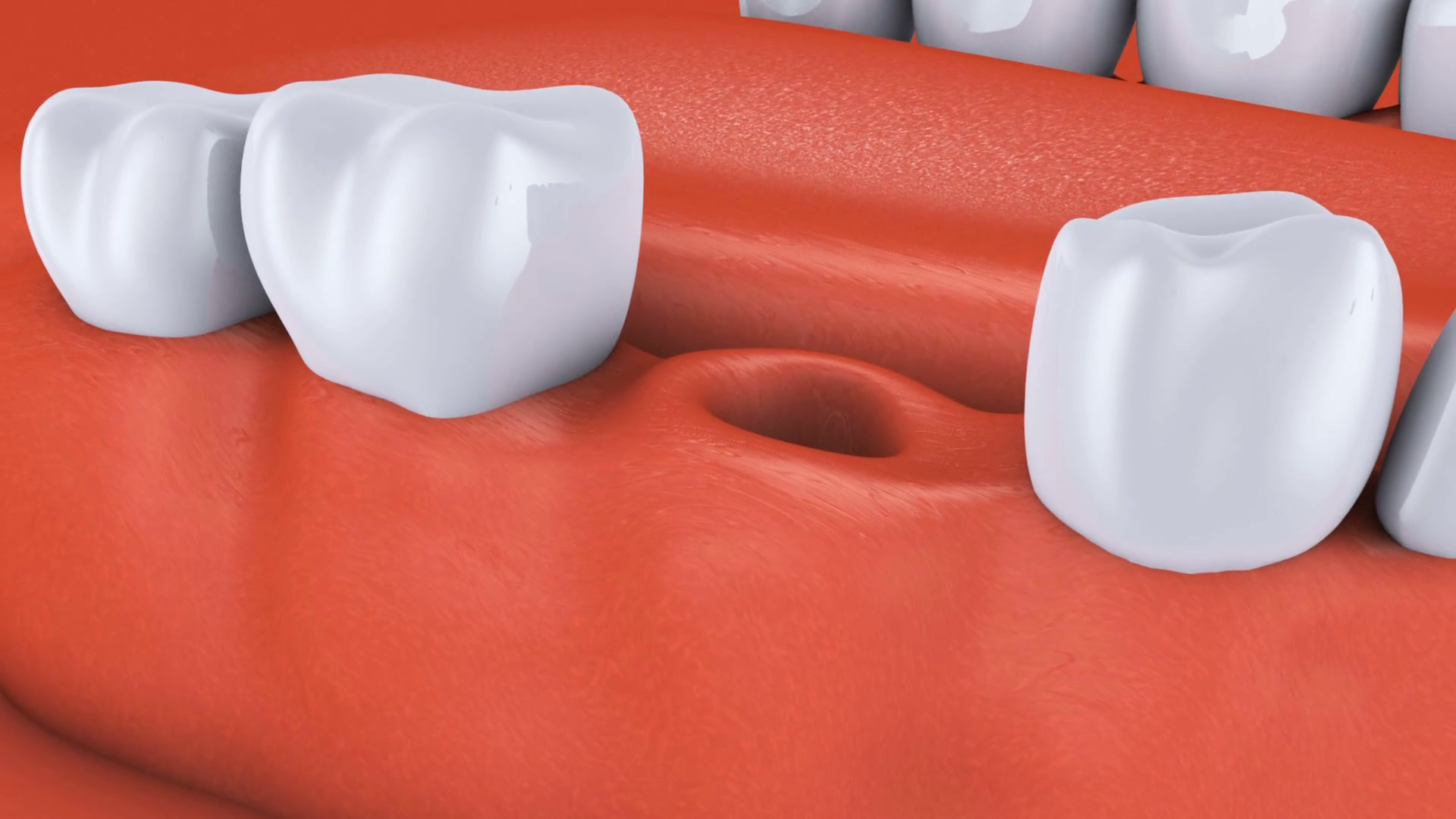 Animation Dental Brackets Tooth Implant 3d Stock Motion Graphics SBV ...