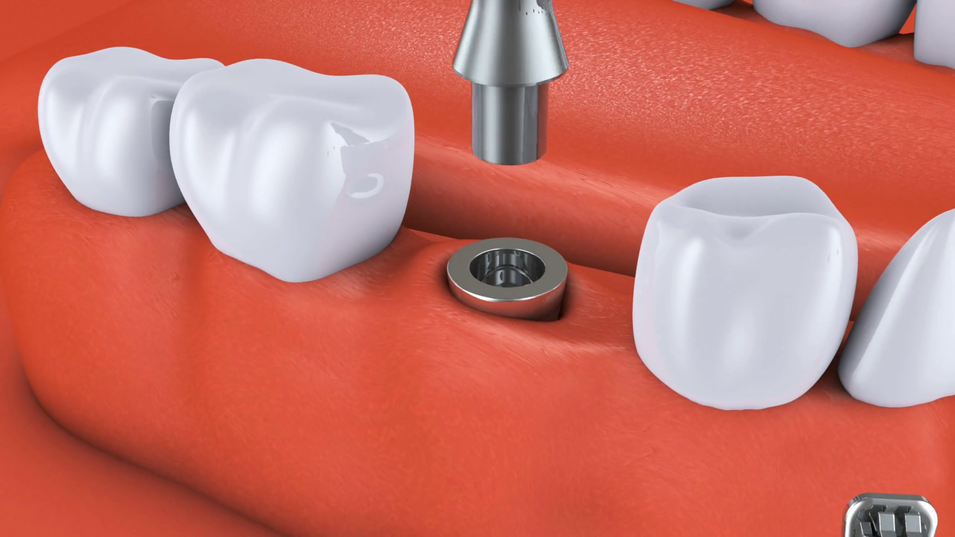 Animation dental brackets and tooth implant. 3D render. Motion ...