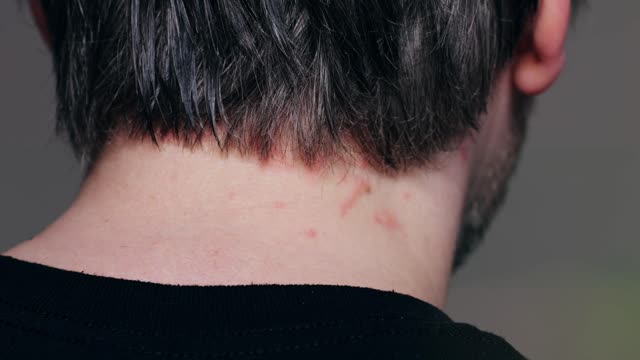 Hives Skin Stock Footage: Royalty-Free Video Clips - Storyblocks