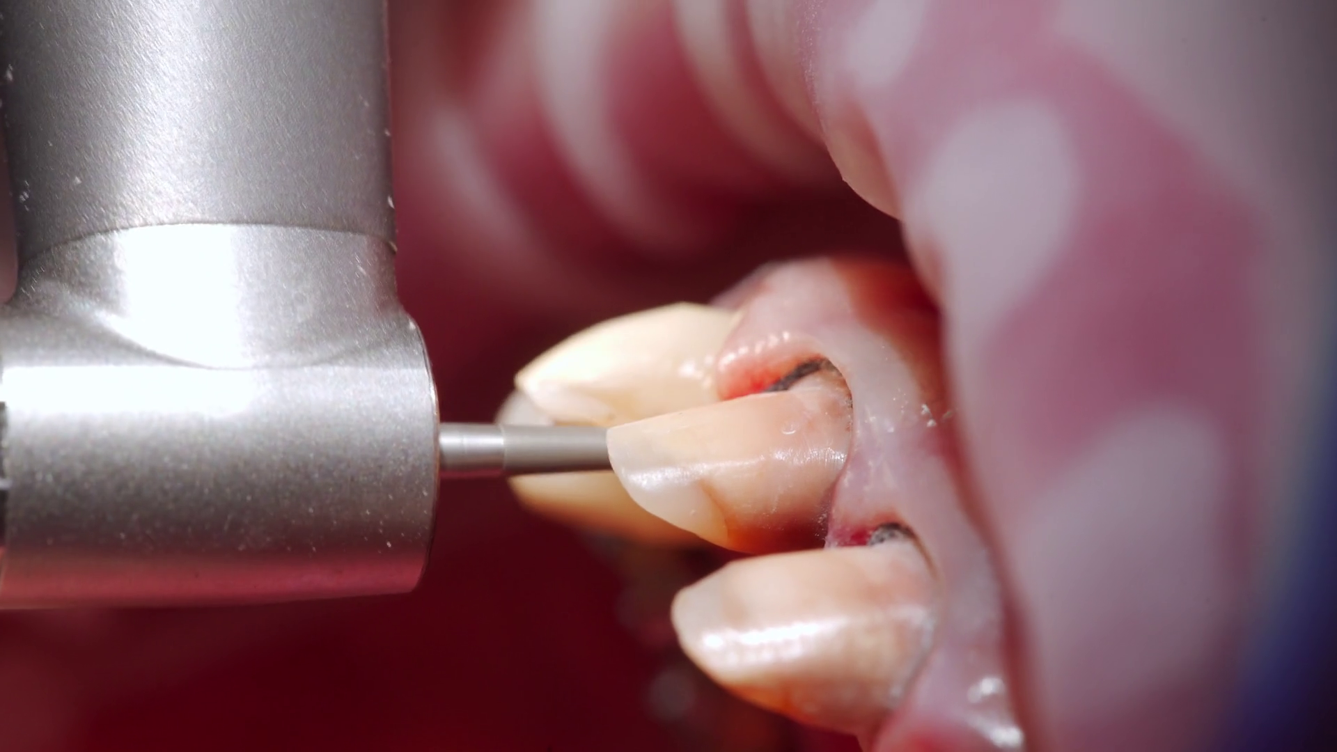 Close-up Macro Shot Of Removing Tooth Enamel Stock Footage SBV ...