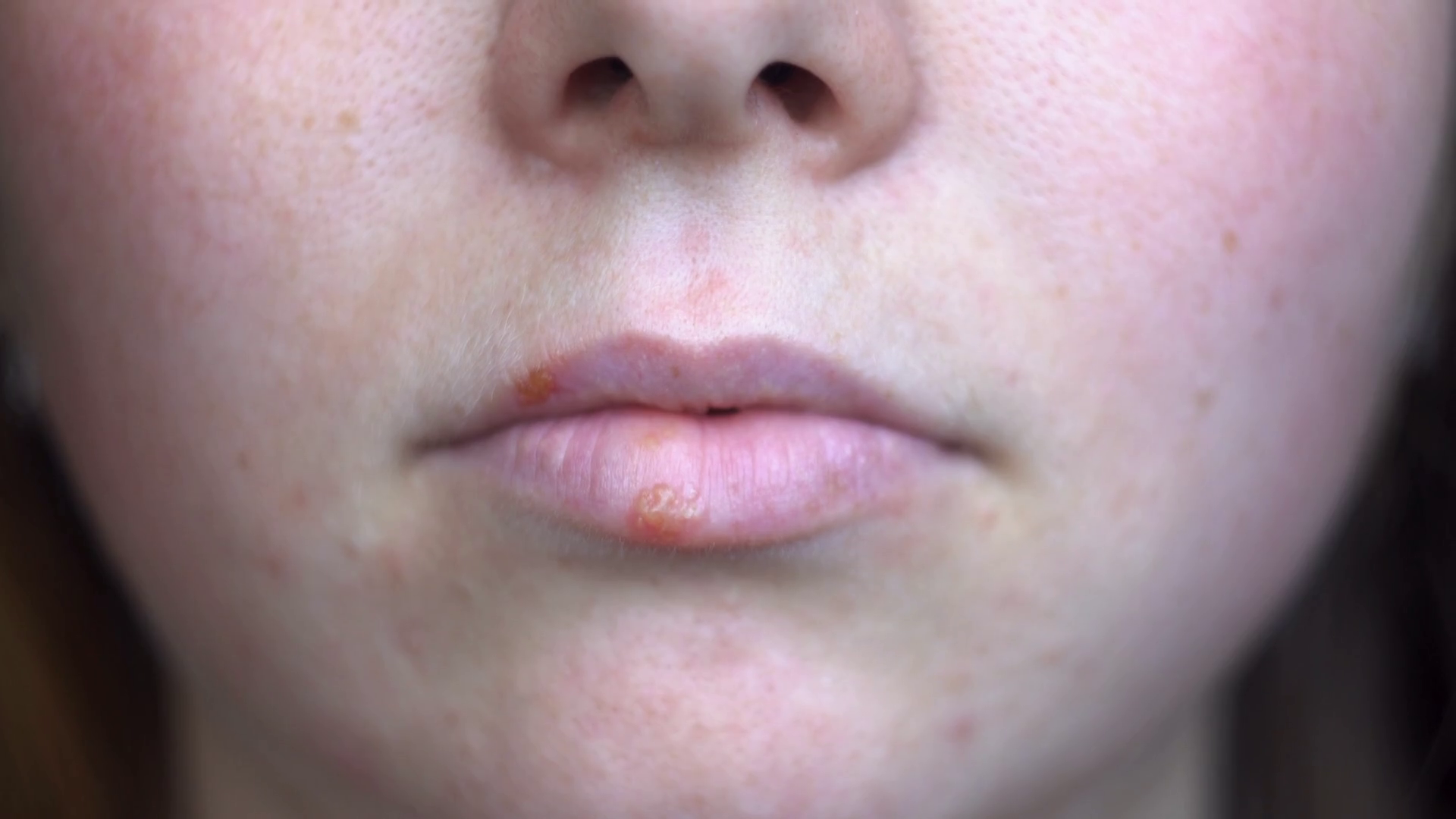 Close Up Of Female Lips Infected Herpes Stock Footage SBV-348478644 ...