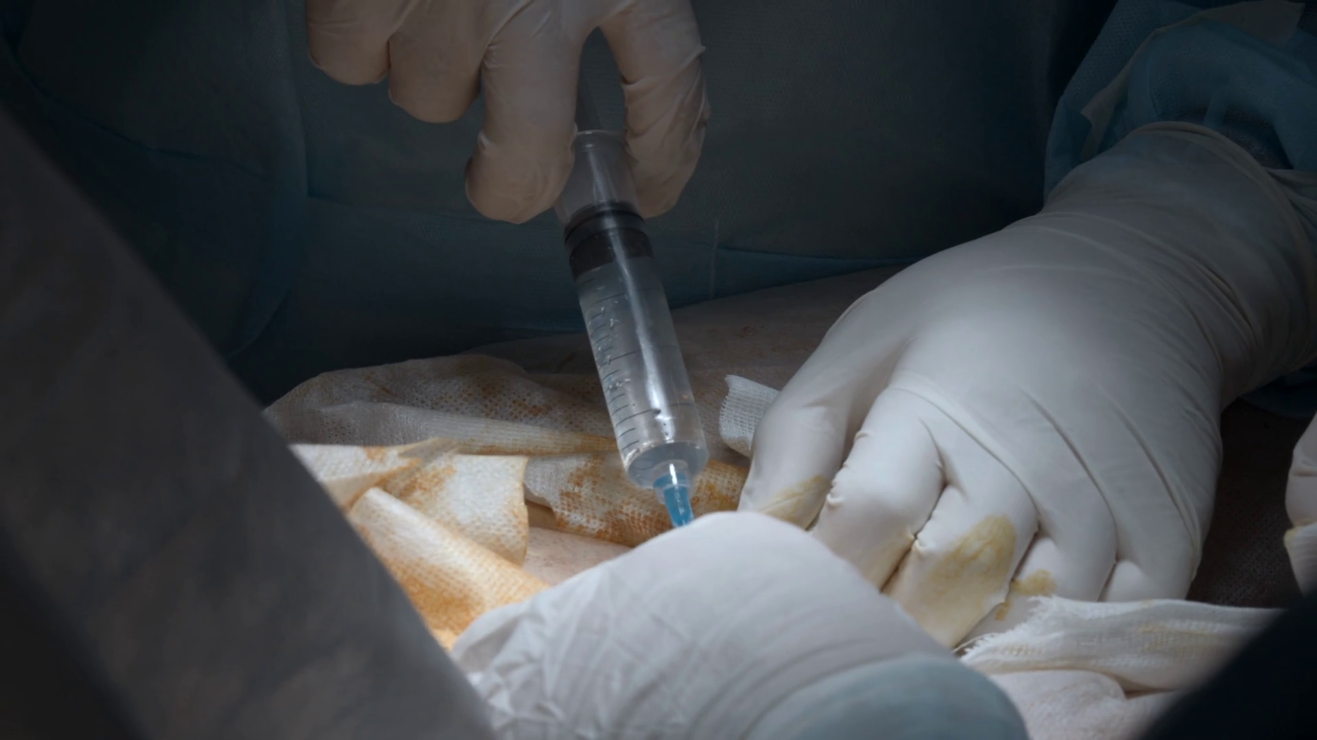 Surgery Operation Close Up Action Hands Of Stock Footage SBV-348563984 ...