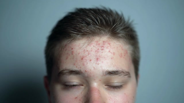 Sun Burnt Face Stock Footage: Royalty-Free Video Clips - Storyblocks