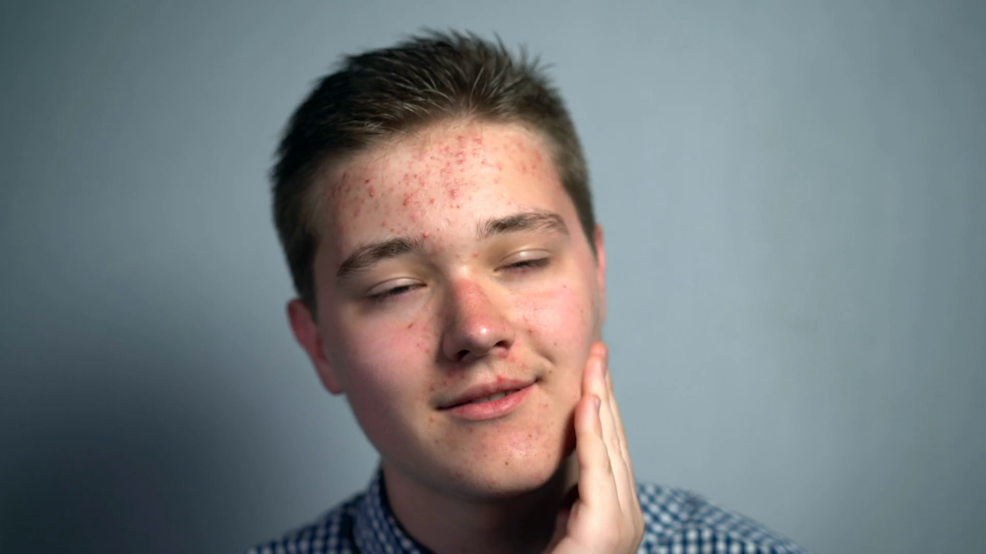 Hands Of Man Scratching Skin Rash Dermatitis Stock Footage SBV ...