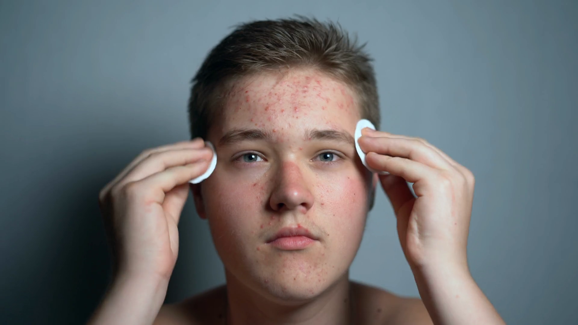 Teenage Boy With Problem Of Acne During Stock Footage Sbv 324456150