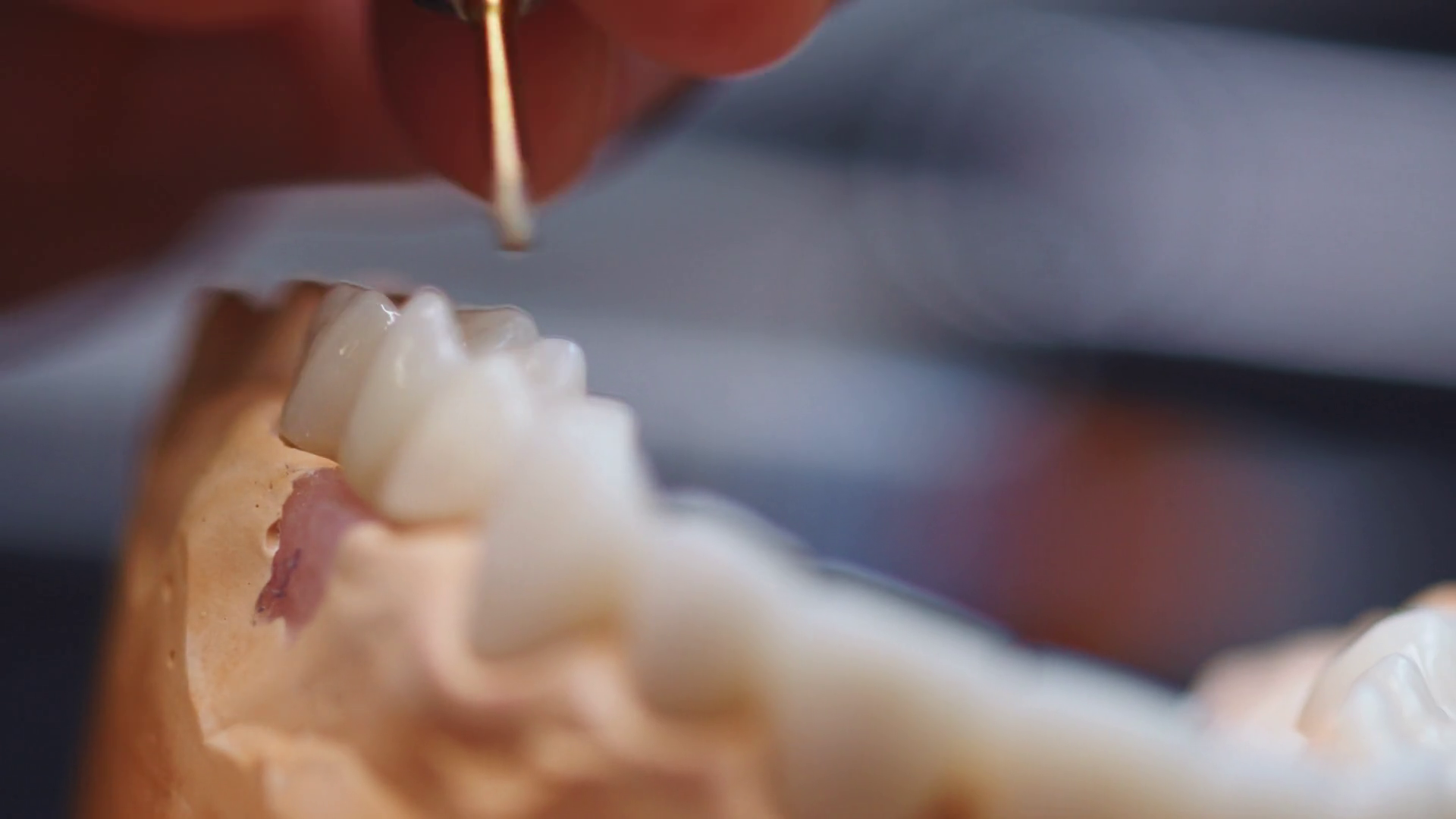 Hands Setting Dental Tooth Crown On Jaw Stock Footage SBV-352136553 ...
