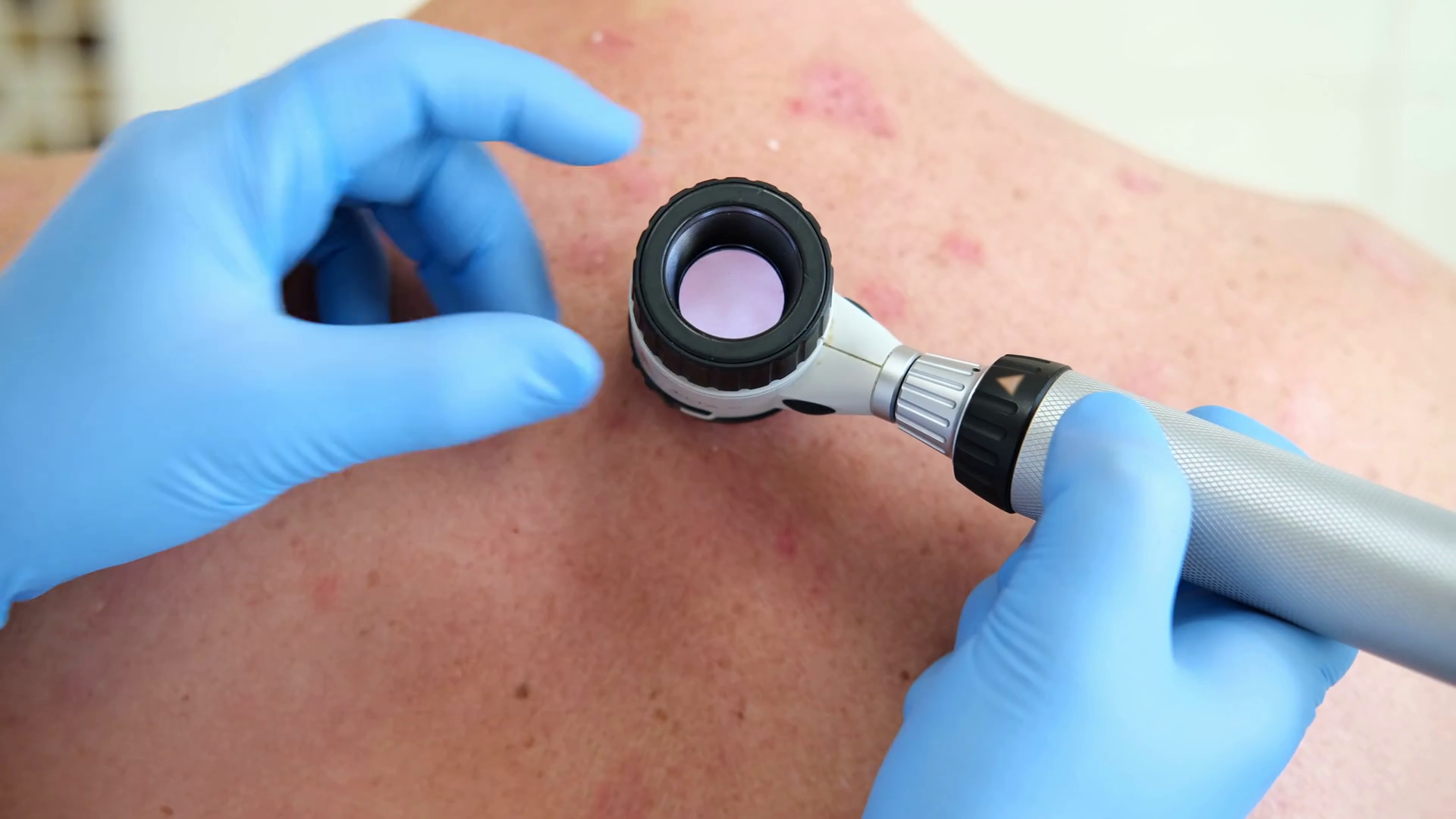 A Dermatologist Examines Patient's Skin Stock Footage SBV-348460098 ...