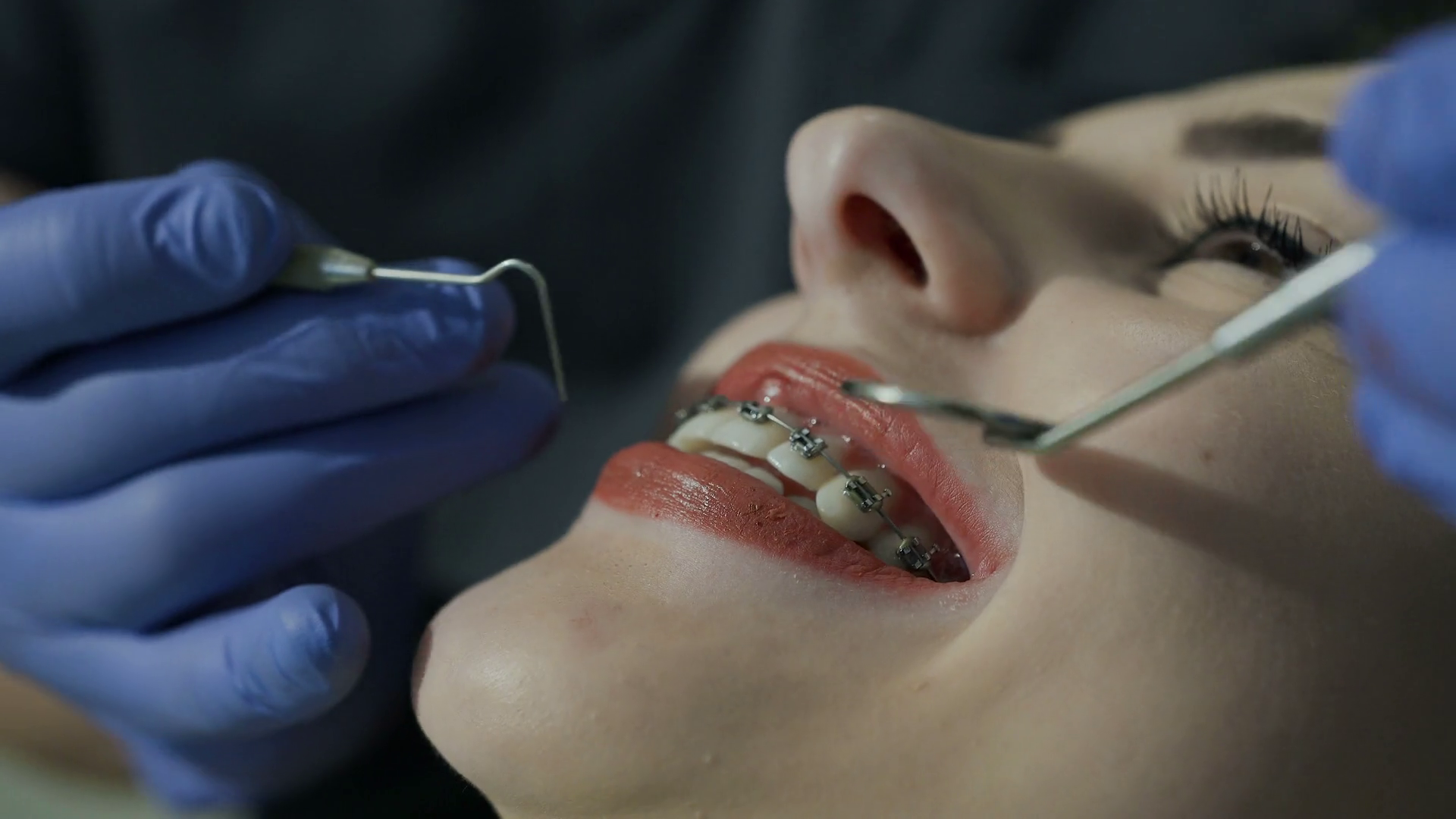 Healthy Teeth Closeup Patientt Smiling Stock Footage SBV-318802296 ...