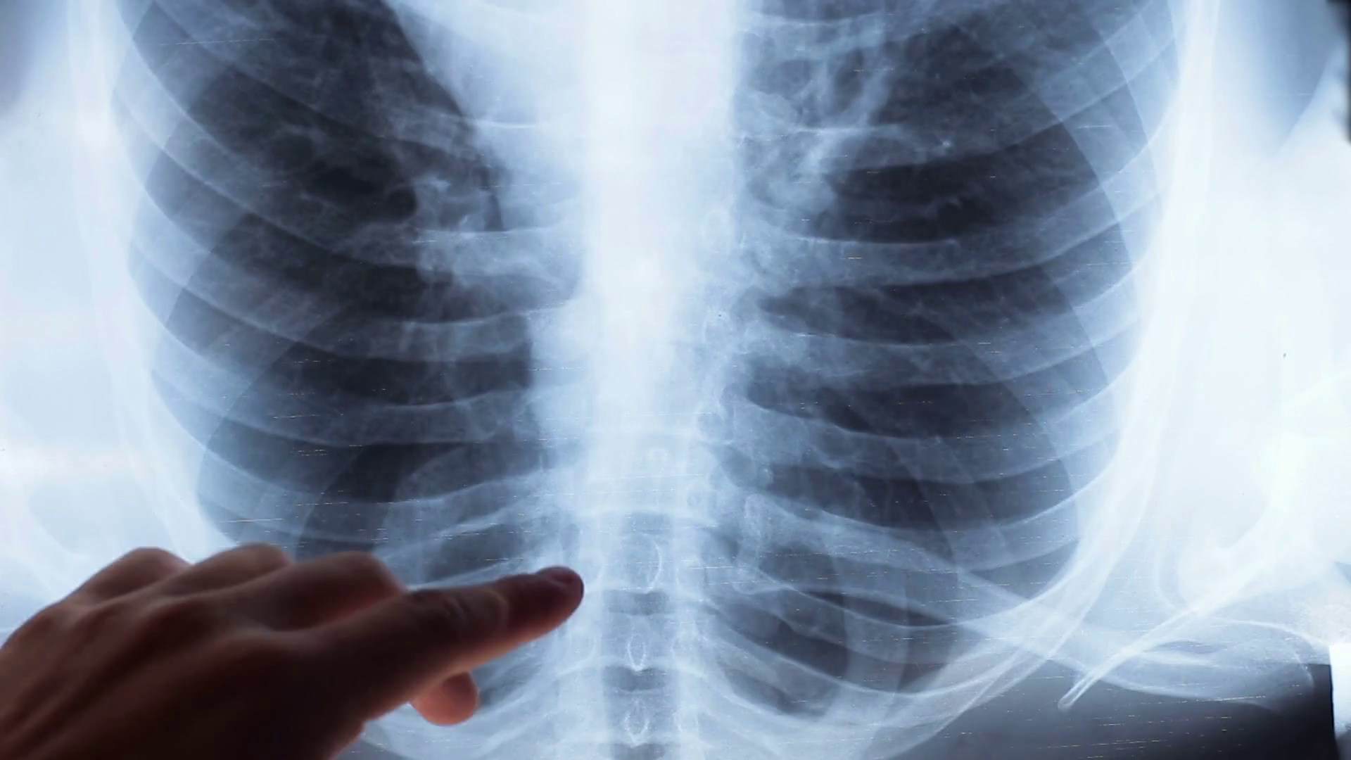 A Picture Of X-ray Of Healthy Lungs Doctor Stock Footage SBV-330518635 ...