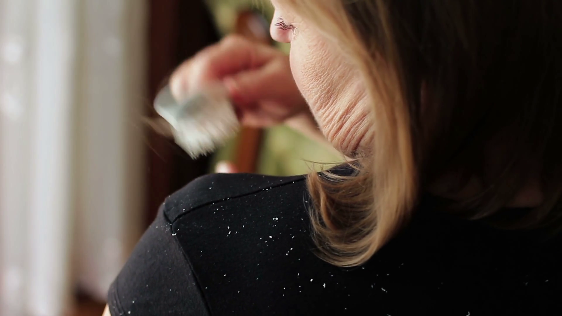 Dandruff on woman's clothes. problem skin with dandruff in a woman ...