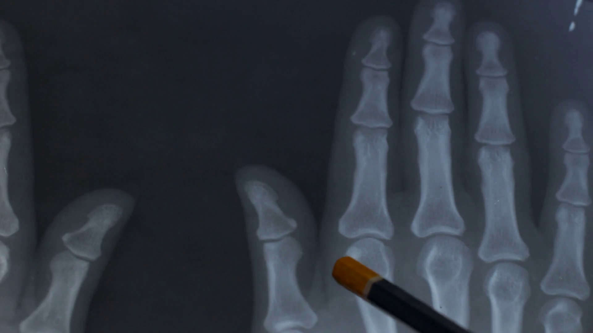 Doctor Examining X-ray Of Hand Arthritis Stock Footage SBV-316274981 ...