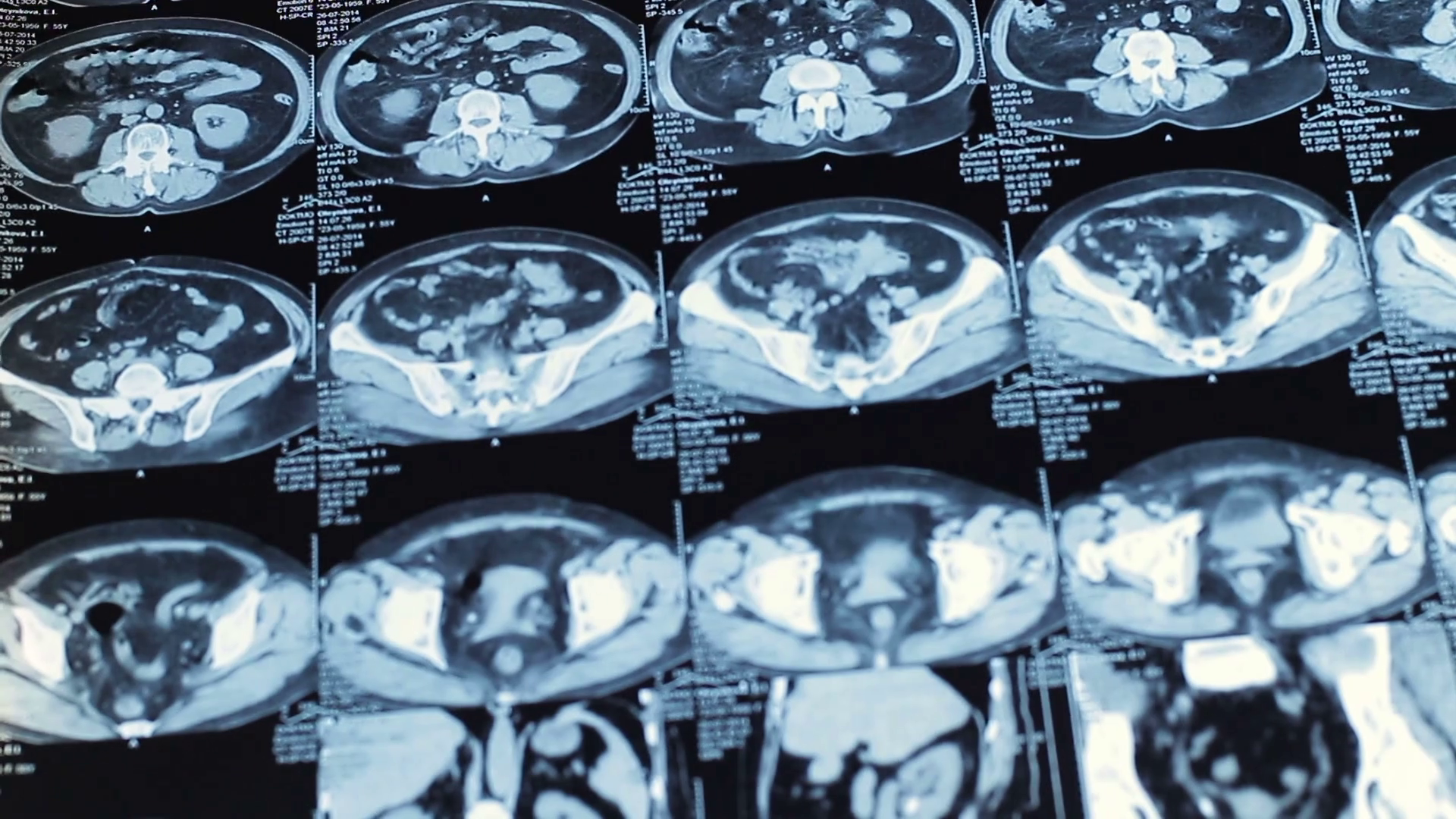 MRI of kidneys. Magnetic resonance imaging. Close up Stock Video ...