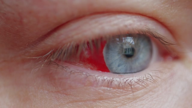 Pink Eye Disease Stock Footage: Royalty-Free Video Clips - Storyblocks