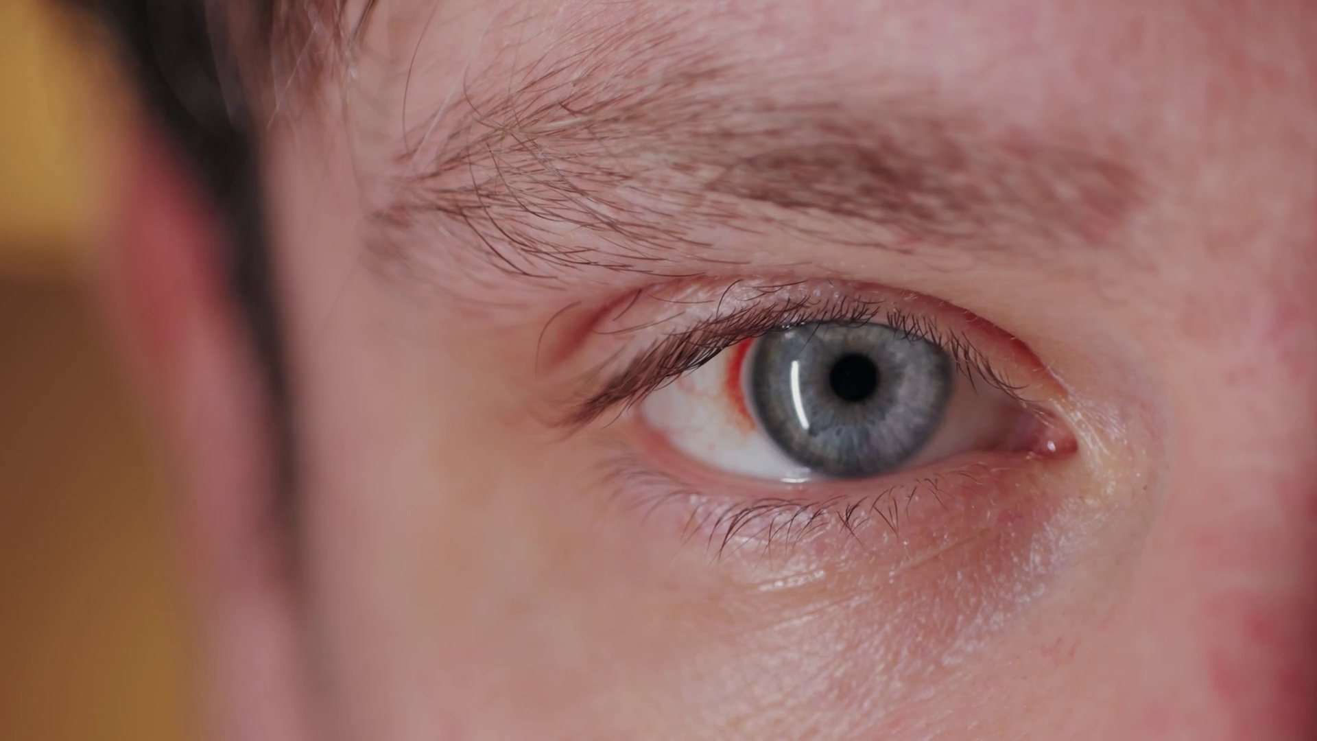 Eye Injury Close Up Blood In Eye Damage Stock Footage SBV-348766123 ...