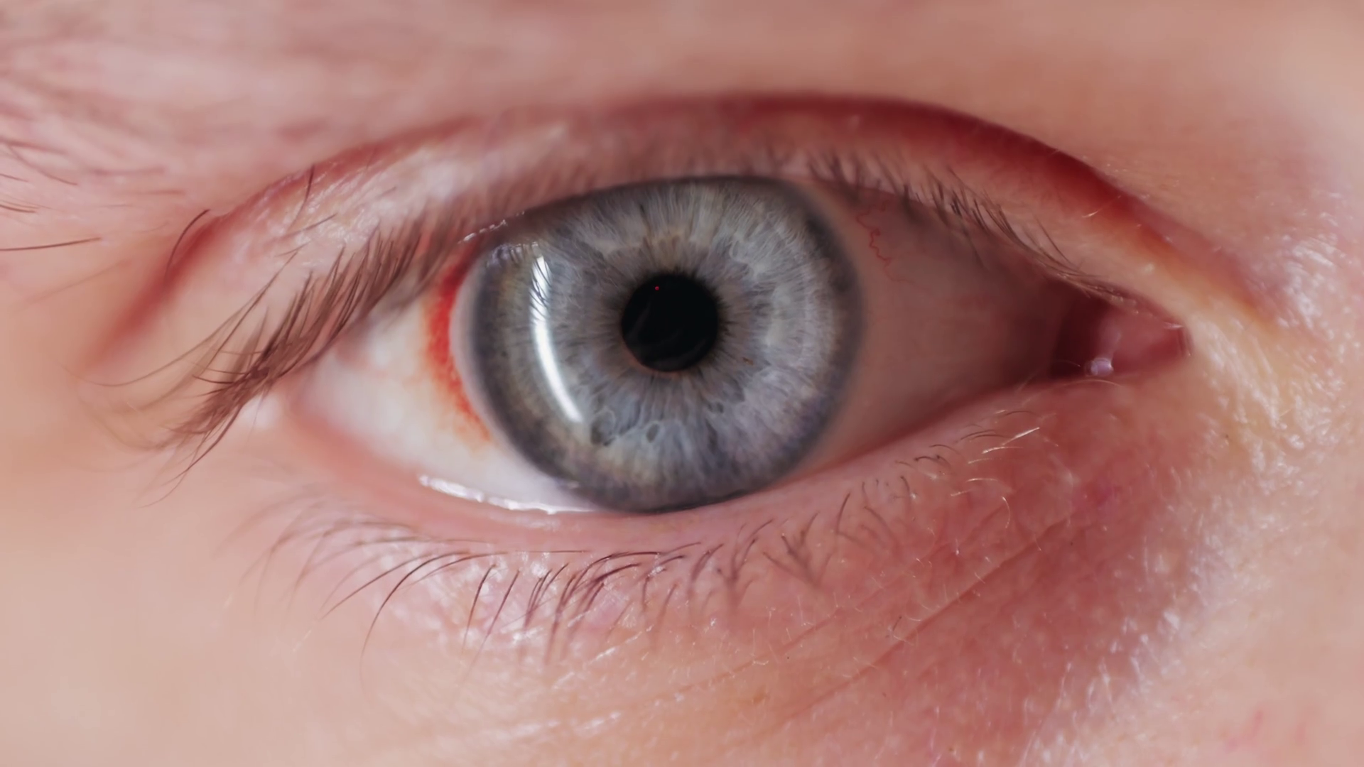 Eye Injury Close Up Blood In Eye Damage Stock Footage SBV-347742285 ...