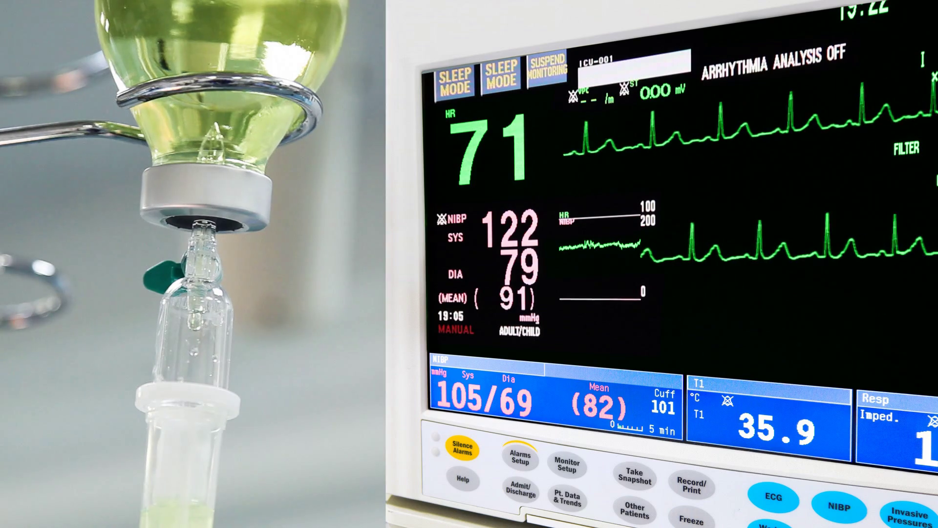 Iv Drip With Ecg Monitor Stock Footage SBV-301158508 - Storyblocks