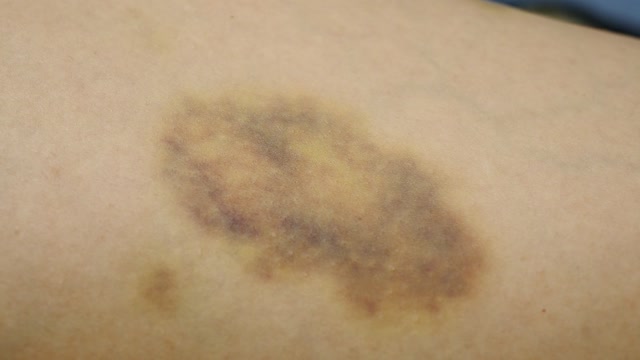 Bruise Skin Stock Footage: Royalty-Free Video Clips - Storyblocks