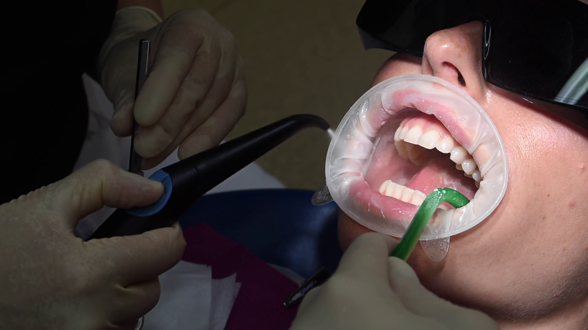 Dental Extreme Close Up Macro Video Cleaning Stock Footage SBV ...
