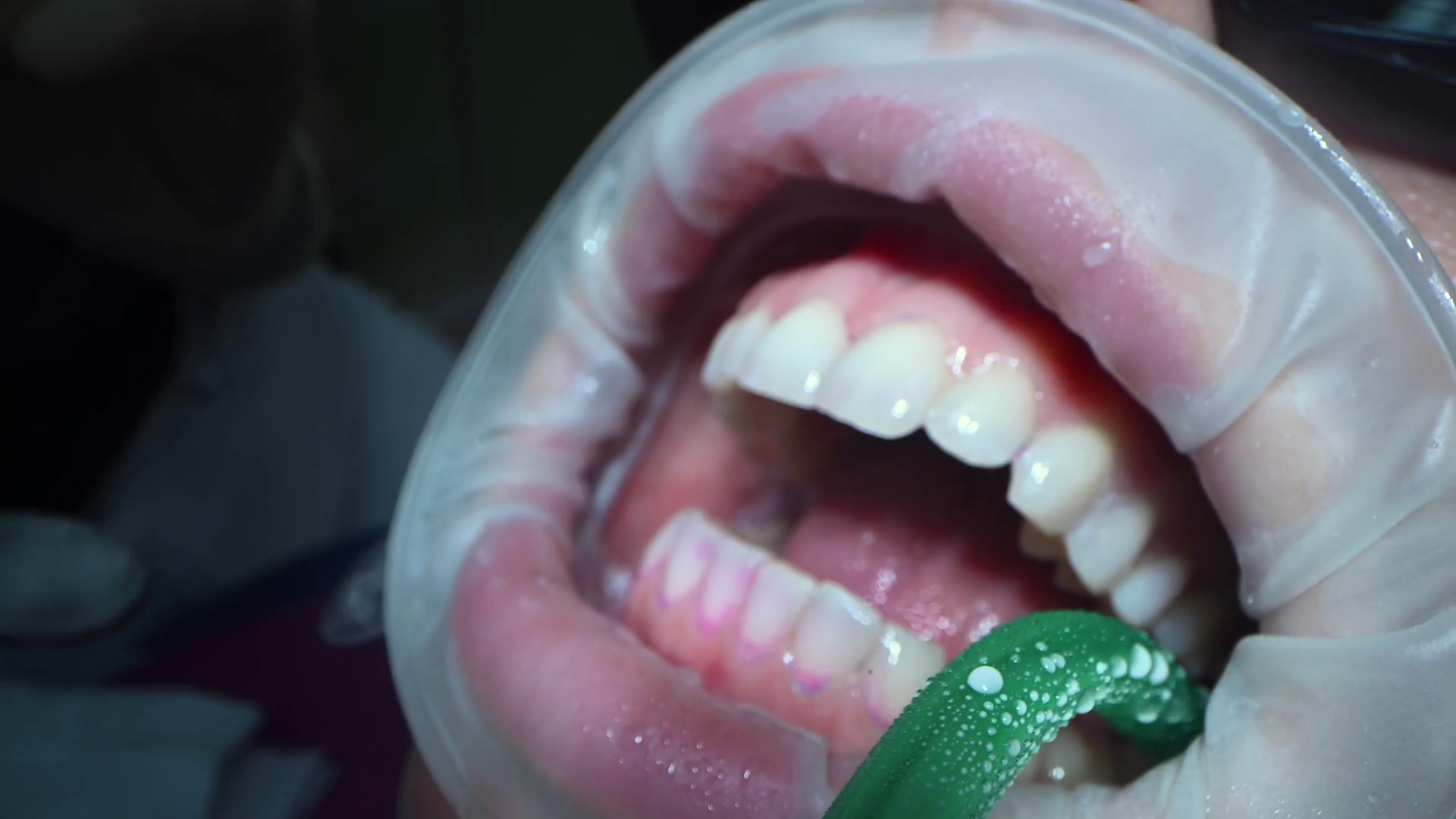 Detailed View Of Persons Teeth Being Stock Footage SBV-351848462 ...