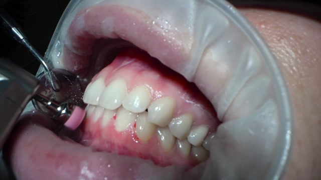 Bleeding Teeth Stock Footage: Royalty-Free Video Clips - Storyblocks