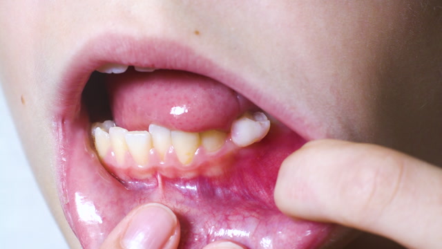 Blood Teeth Stock Footage: Royalty-Free Video Clips - Storyblocks