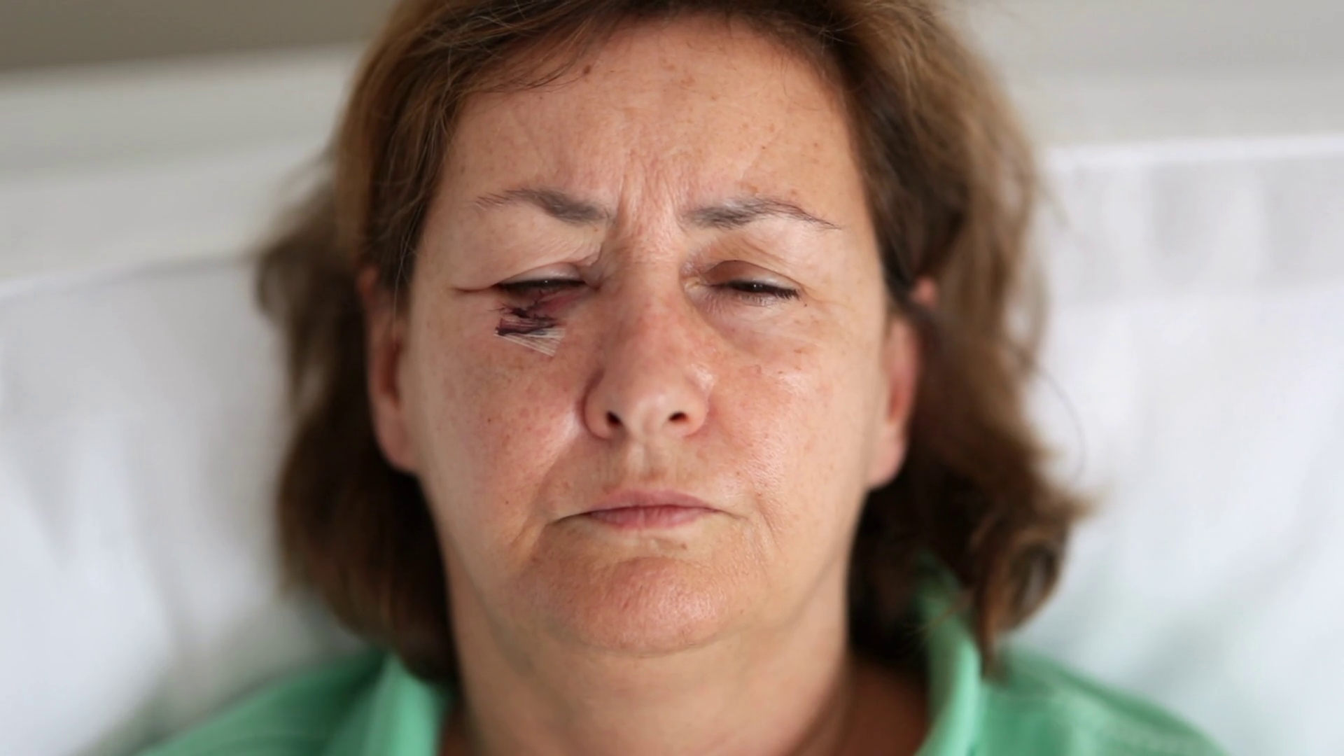 Portrait Of Scarred Bruised Older Woman Stock Footage SBV-348480604 ...