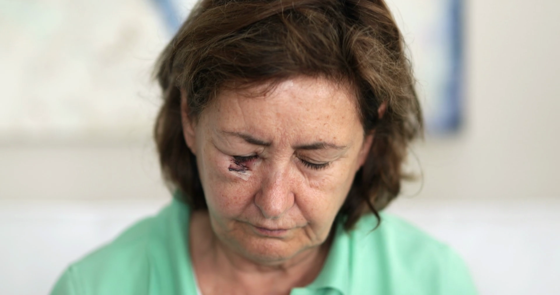 Sad Looking Woman With Injured Bruised Face Stock Footage SBV-348480620 ...