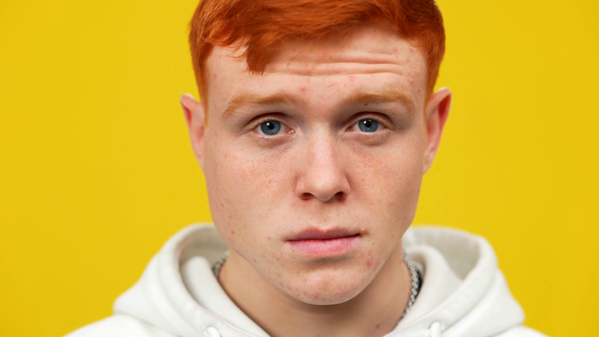 Close-up face of young redhead man with problematic skin posing at ...