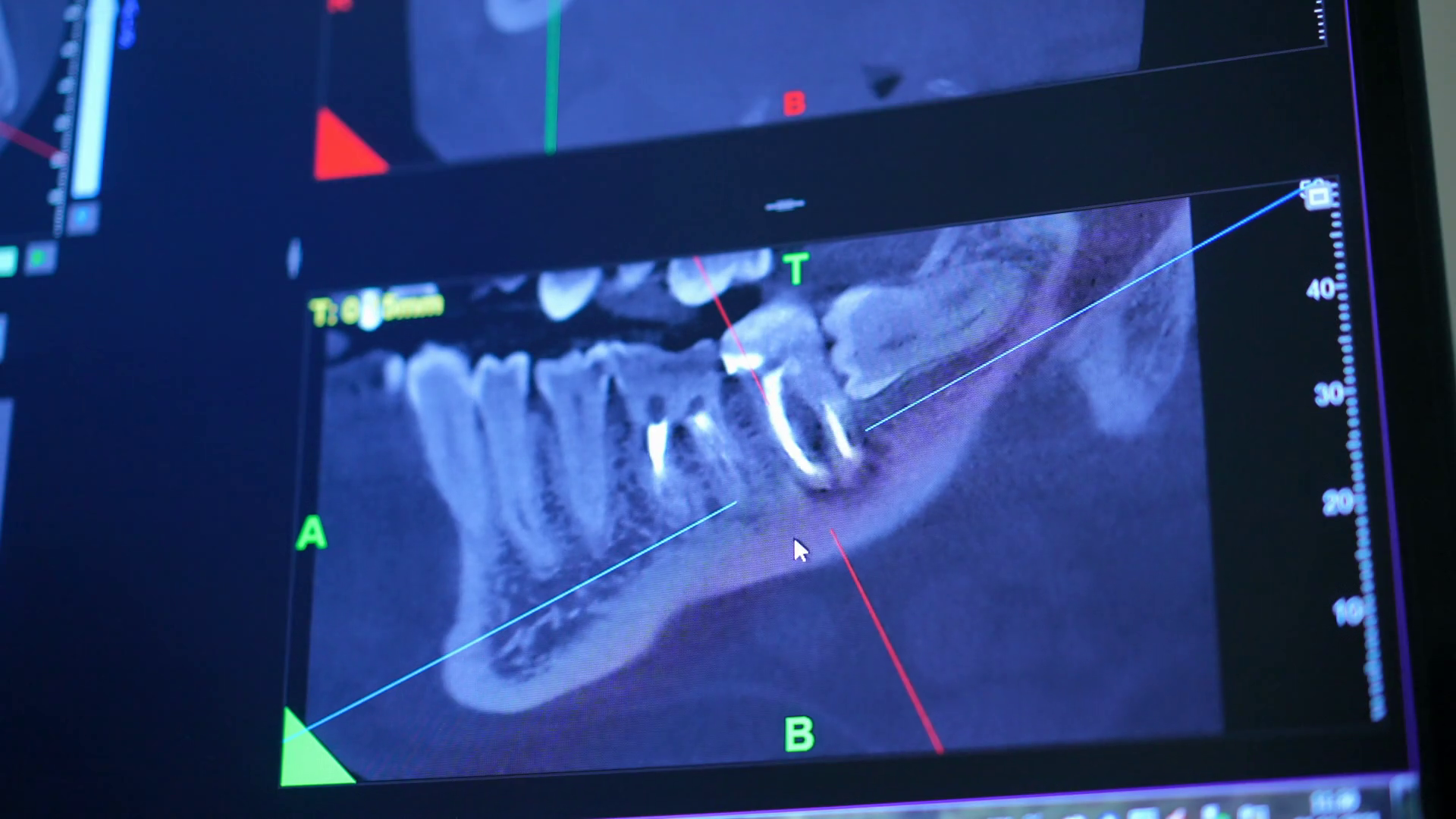 Close-up Screen With 3d Dental Imaging In Stock Footage SBV-347067267 ...