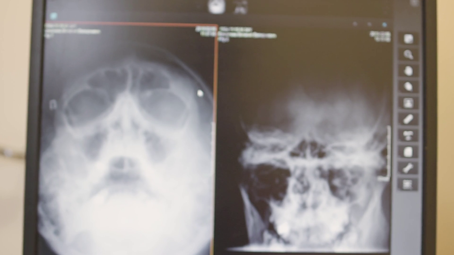 X-ray On Computer Screen Stock Footage SBV-333069525 - Storyblocks