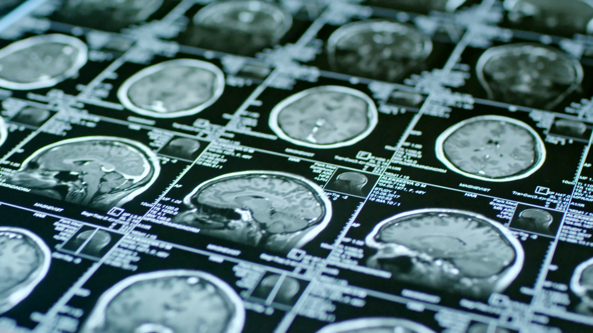 Close Up Of Mri Scan Of Brain With Coronal Stock Footage SBV-318138275 ...