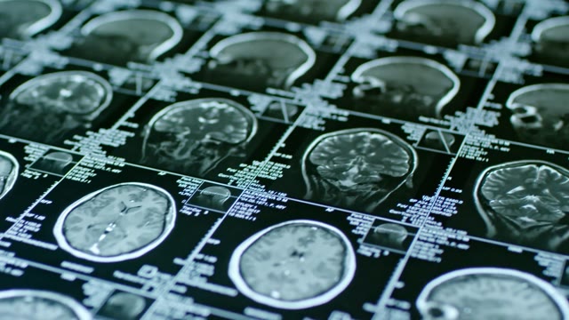 MRI Scan Brain Stock Footage: Royalty-Free Video Clips - Storyblocks