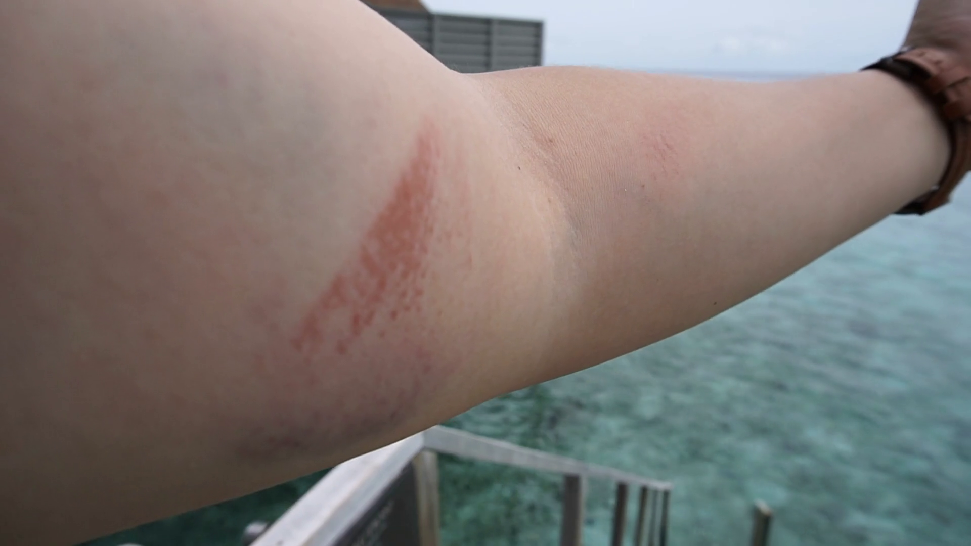 Arm Bruise Slippery From Stair Under Sea Stock Footage SBV-338599483 ...