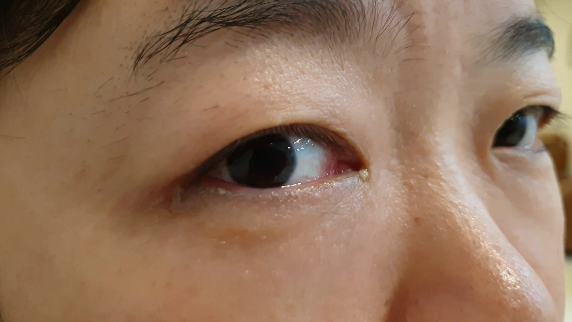 Conjunctivitis Red Pink Eyes Infected With Stock Footage SBV-348372548 ...