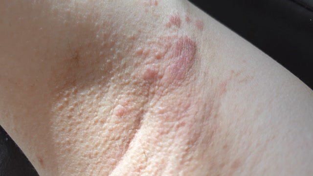 Skin Rashes Stock Footage: Royalty-Free Video Clips - Storyblocks