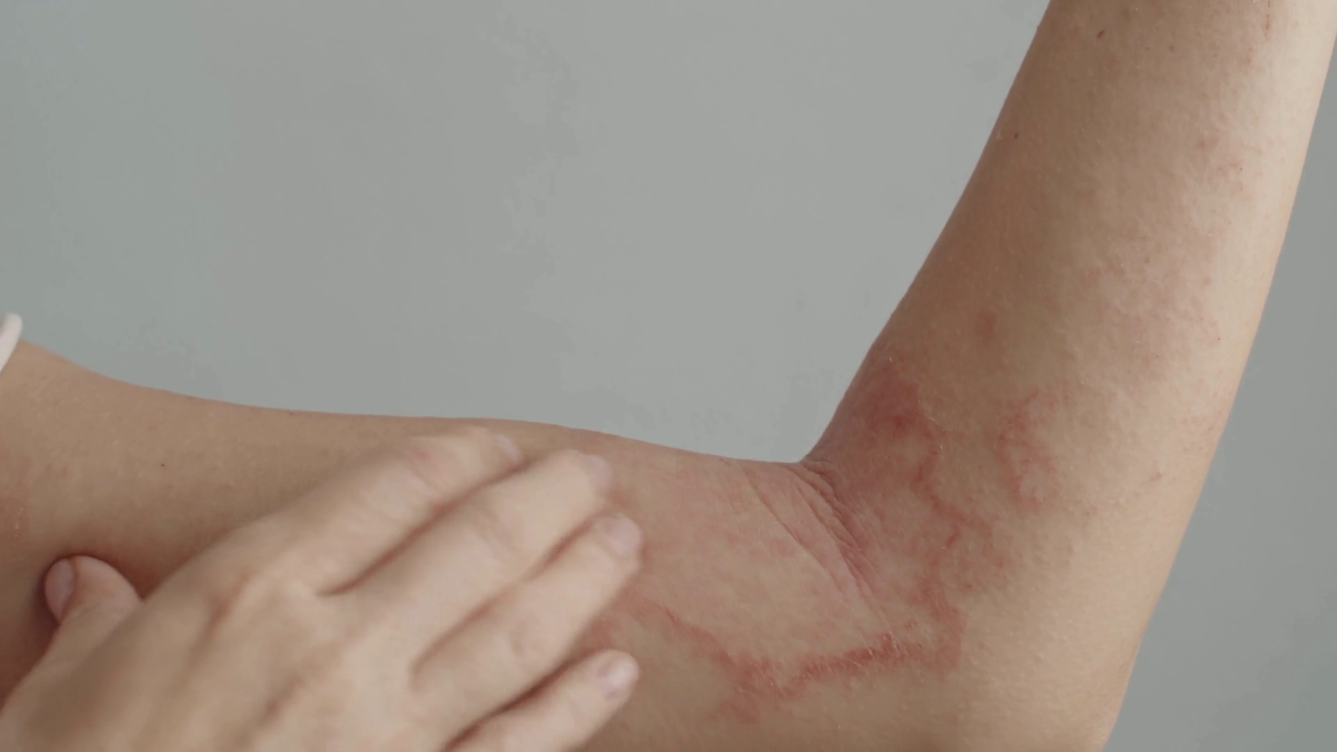 woman scratches her arm with dermatitis Stock Video Footage - Storyblocks