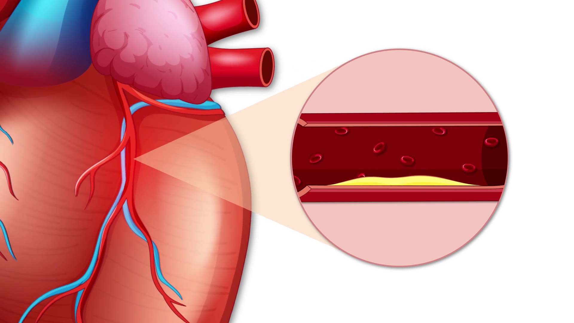 Heart Attack Animation: Plaque Buildup Stock Footage SBV-352402923 ...