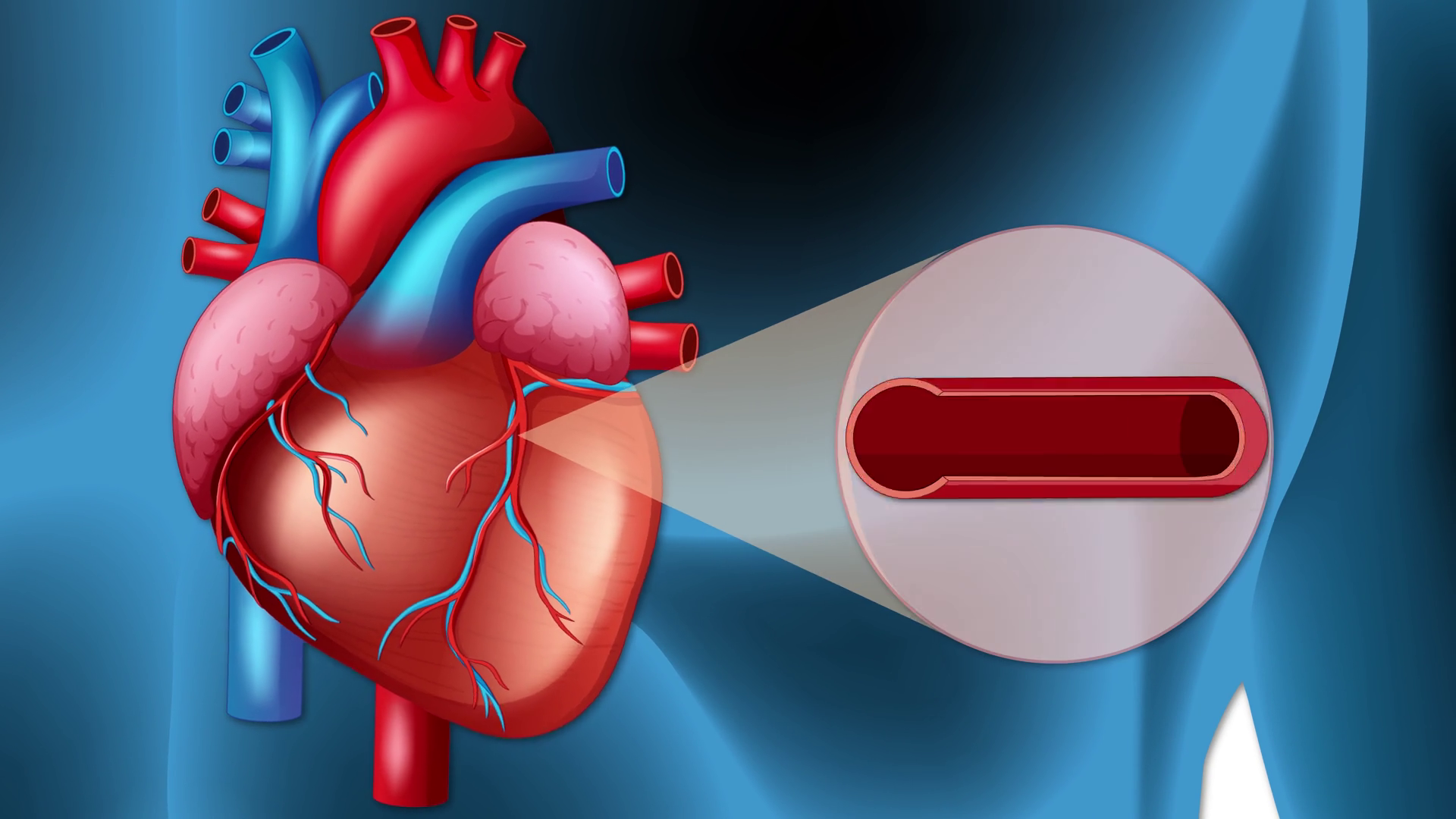 Coronary Artery Disease Animation: Heart Stock Footage SBV-352448014 ...