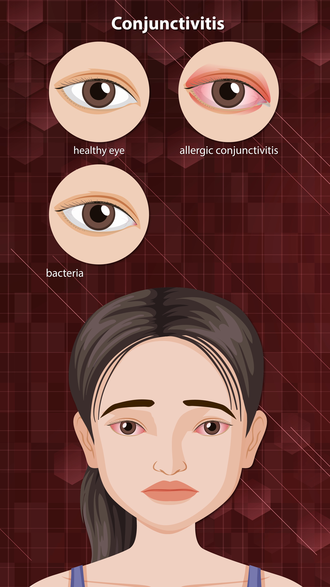Progression Types Of Conjunctivitis In Young Stock Footage SBV ...