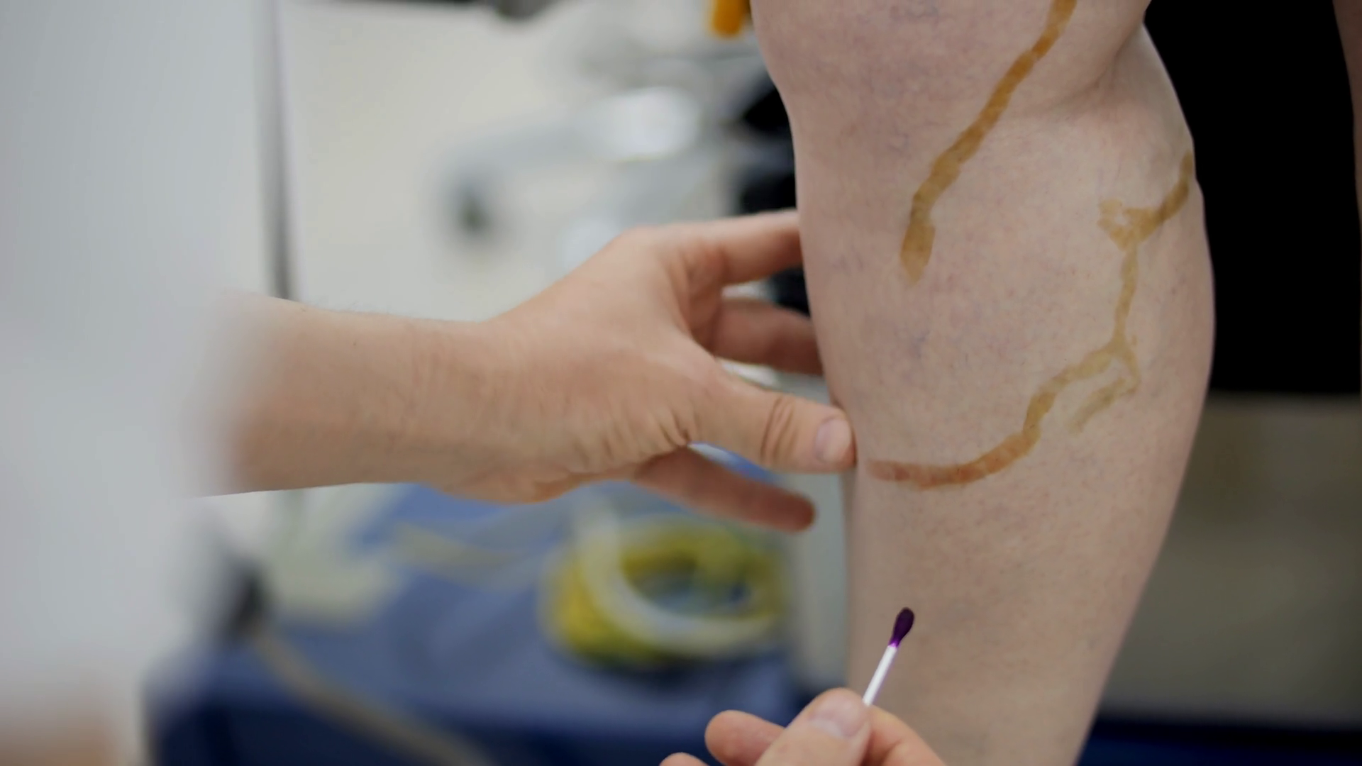 Doctor Marking Veins On Patient Leg Laser Stock Footage SBV-353169767 ...